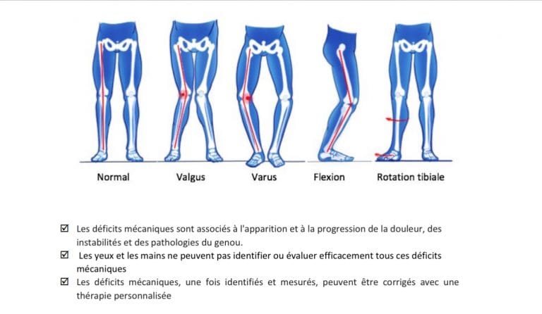Genougraphie (KneeKG) | Clinique Sport Santé Laurentides
